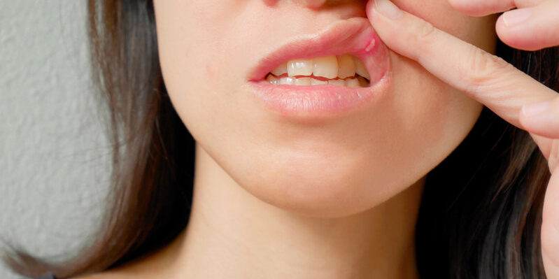 Aftas en la boca. Qué son y cómo tratarlas - Clínica dental Toledo ...
