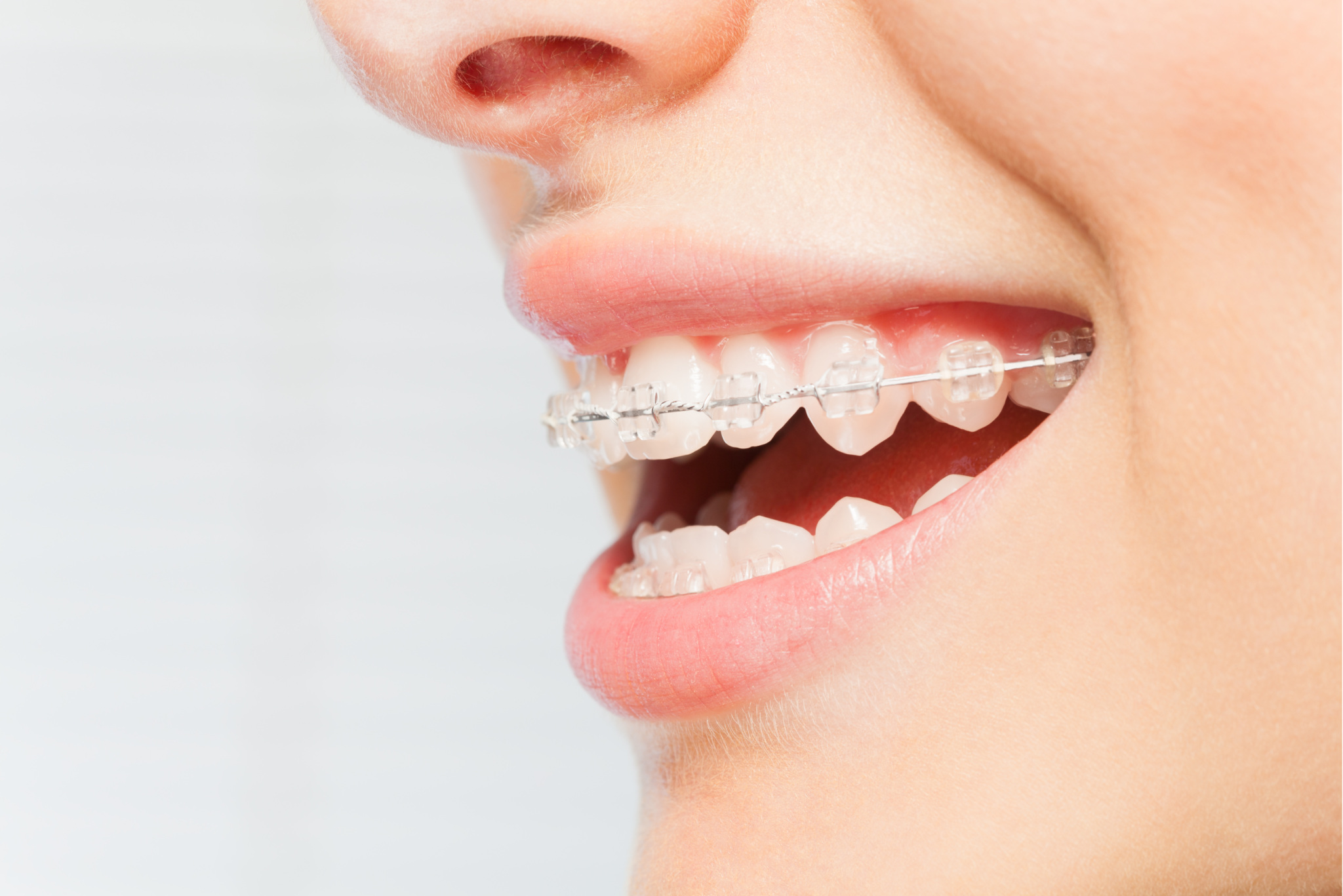 Brackets: tipos y su uso en tratamientos de ortodoncia - Clínica dental ...